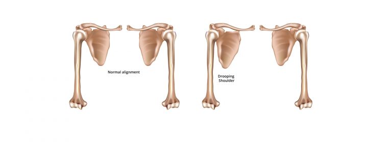 What happens when you try to over correct your shoulder or you notice ...